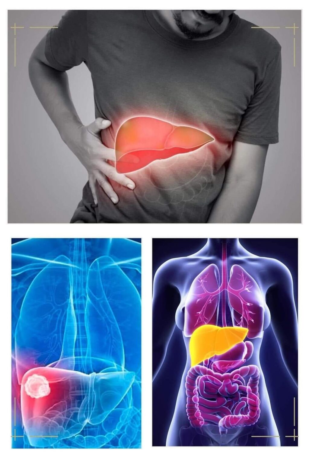 Estos son los síntomas que alertan que tienes hígado graso: descubre ...